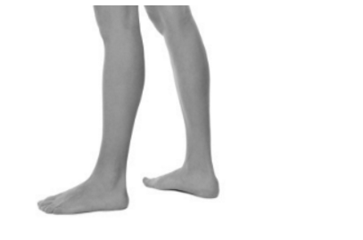 Adult Conditions We Treat - Melbourne Foot, Ankle and Walking Clinic